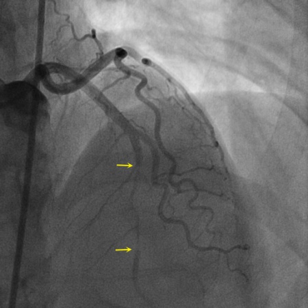 Spontaneous Coronary Artery Dissection - iSCAD Registry