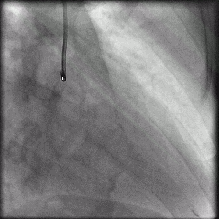 Spontaneous Coronary Artery Dissection - iSCAD Registry