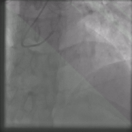 Spontaneous Coronary Artery Dissection - iSCAD Registry